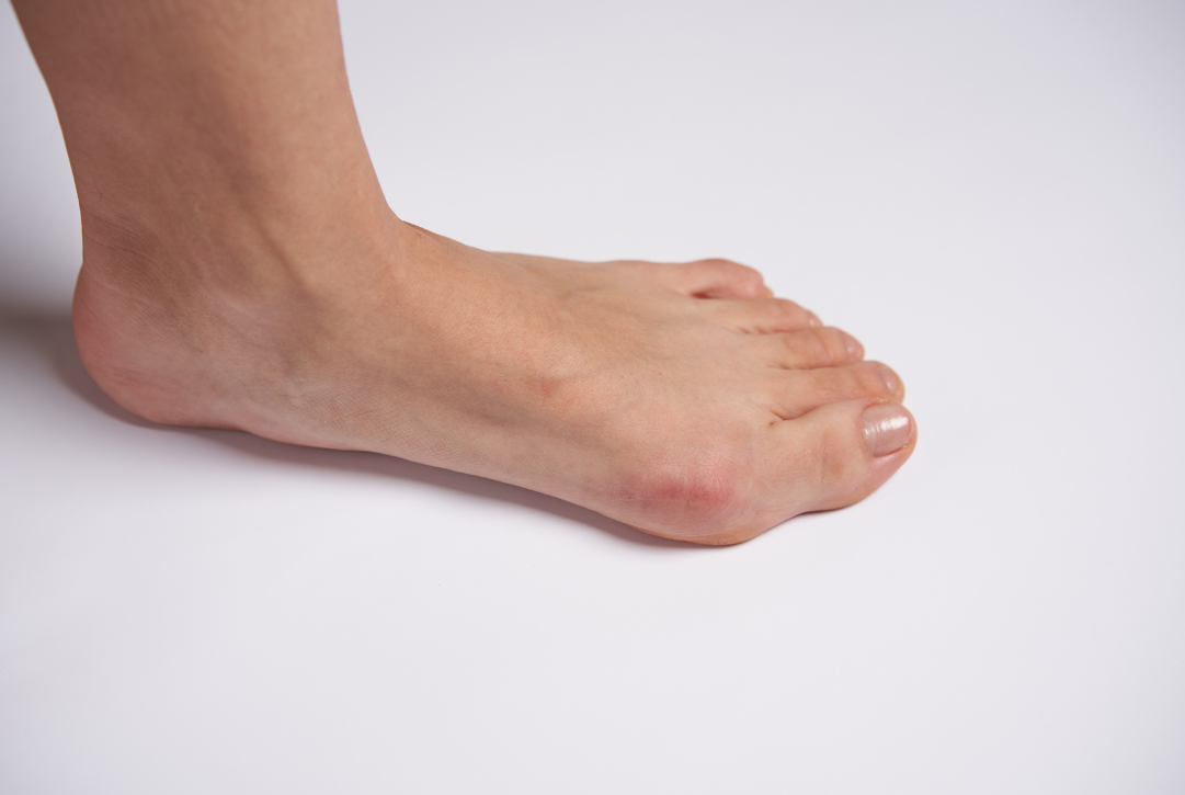 Alluce Valgo: Trattamenti e Soluzioni Efficaci | FootHealth